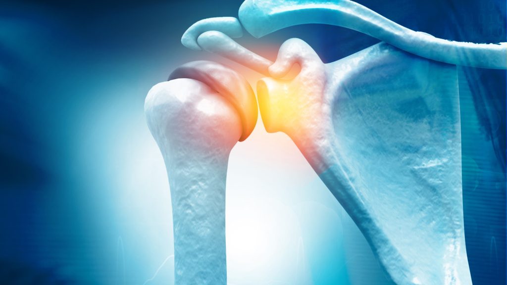 Cedera Rotator Cuff Robek? Ini Cerita Nyata dan Tips Ampuh ...